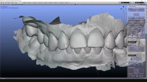 Blender 4 Dental V5.0 (B4D) The Complete Guide For Dental Labs Ready To ...